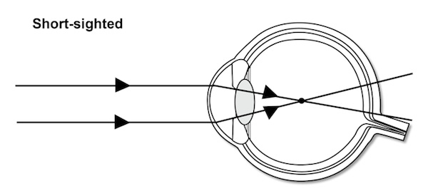 Contact Lenses For Short sightedness Myopia Intervention Contact Lenses For Short sightedness Myopia Intervention